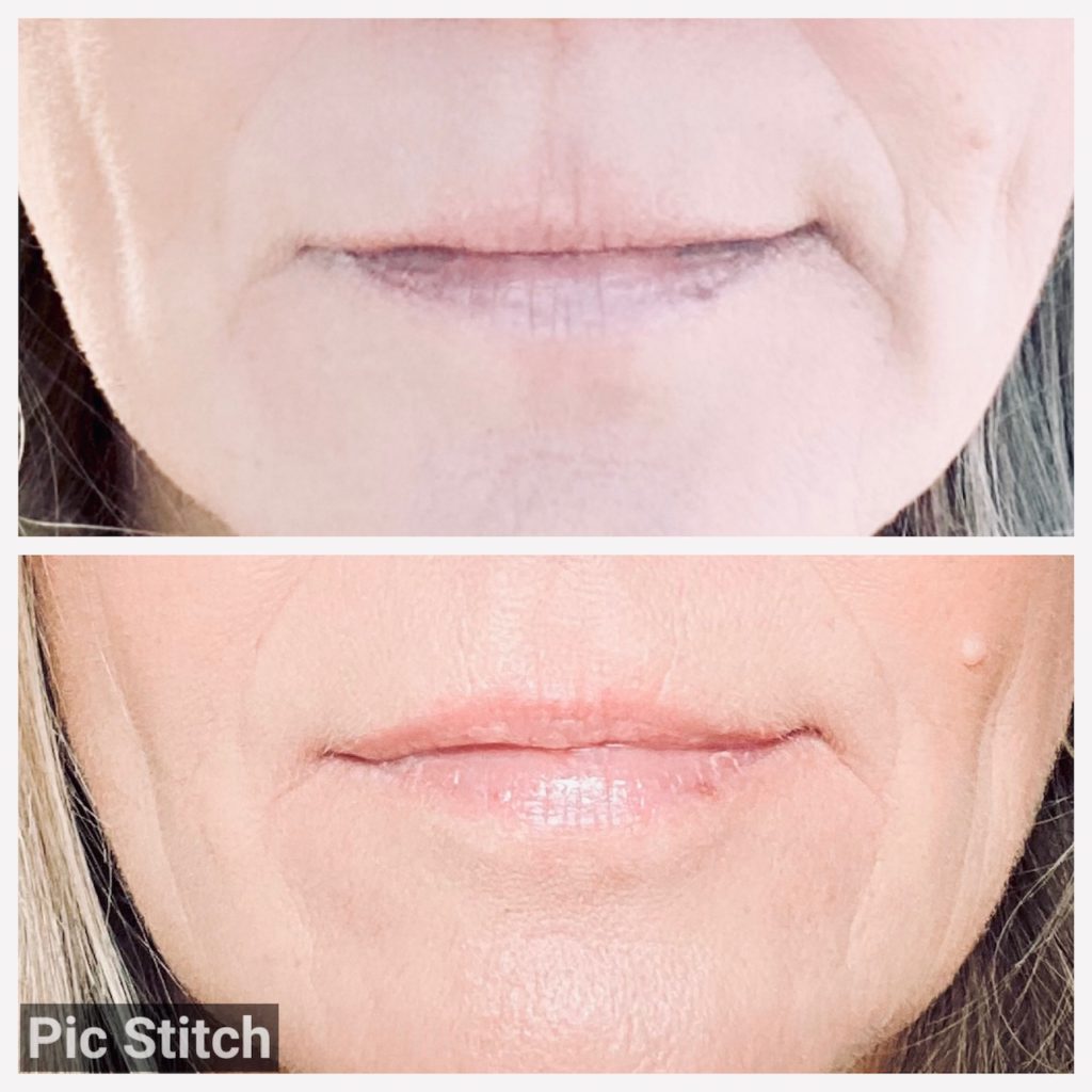 WHAT IS A LIP FLIP? - Not young, not old...somewhere in between